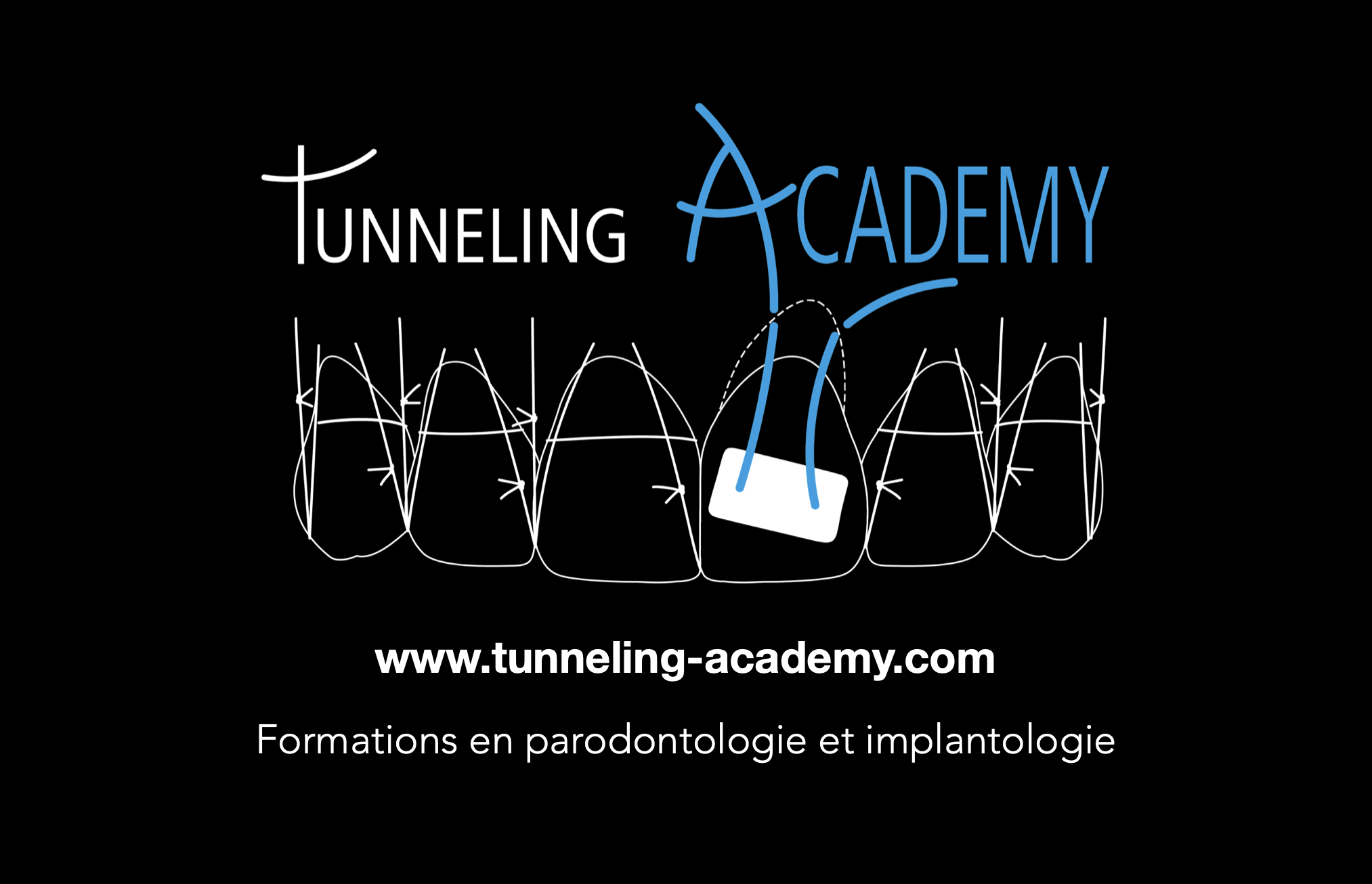 Periodontology Implantology master class - Tunneling Academy
