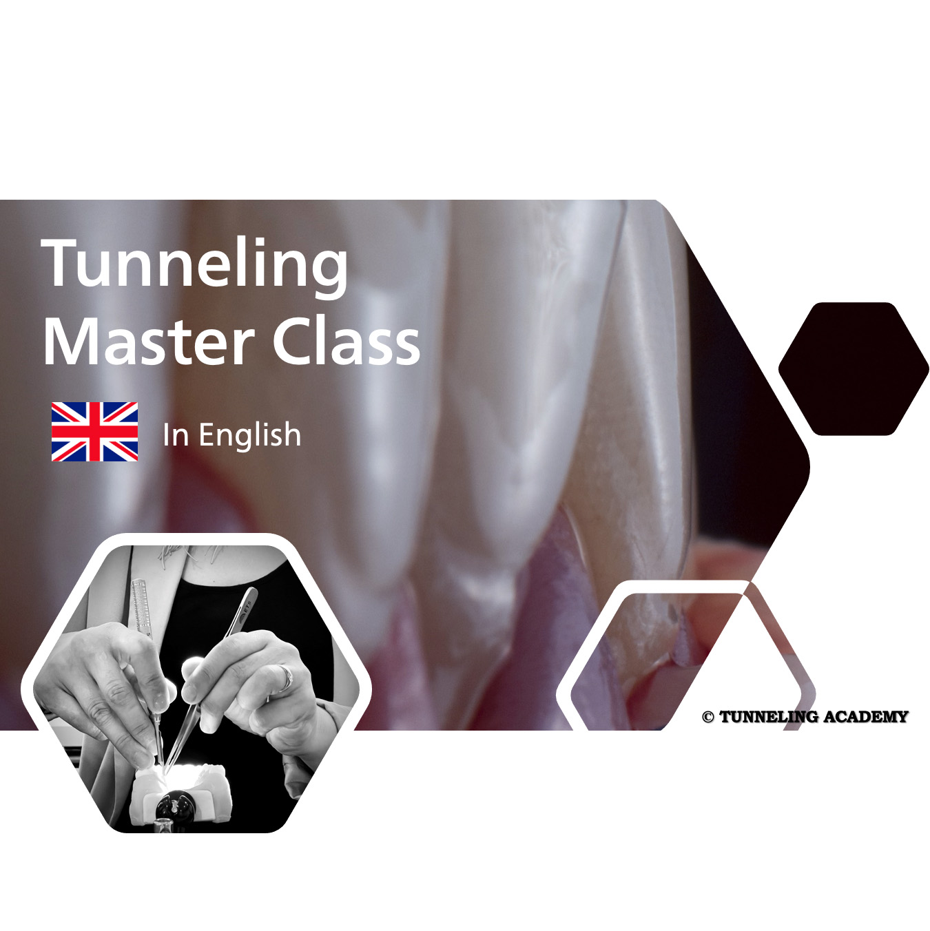 Formation parodontologie implantologie - Tunneling Academy